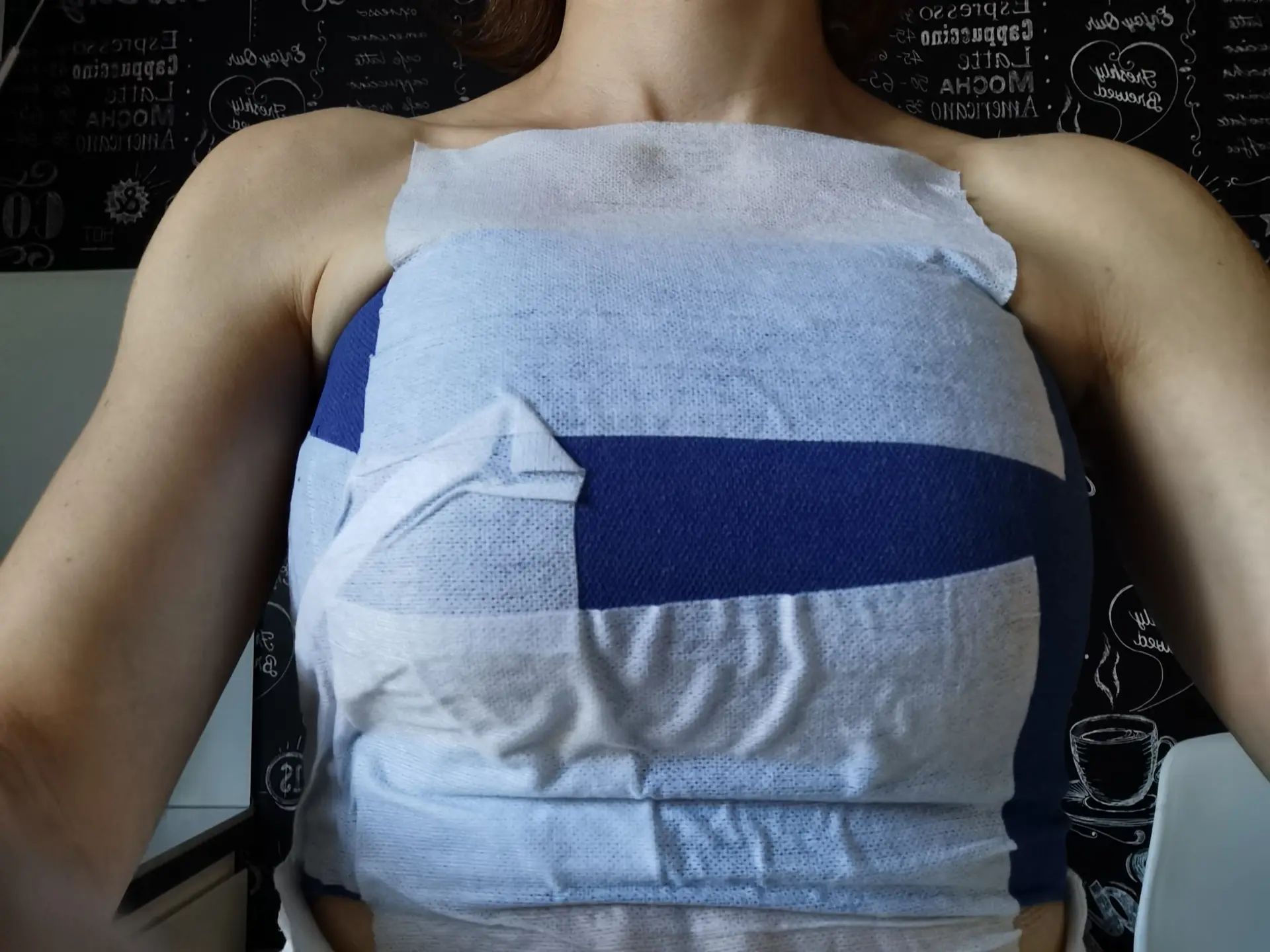 Augmentation Mammaire avec le Dr Taraquois à la Wellness kliniek ...