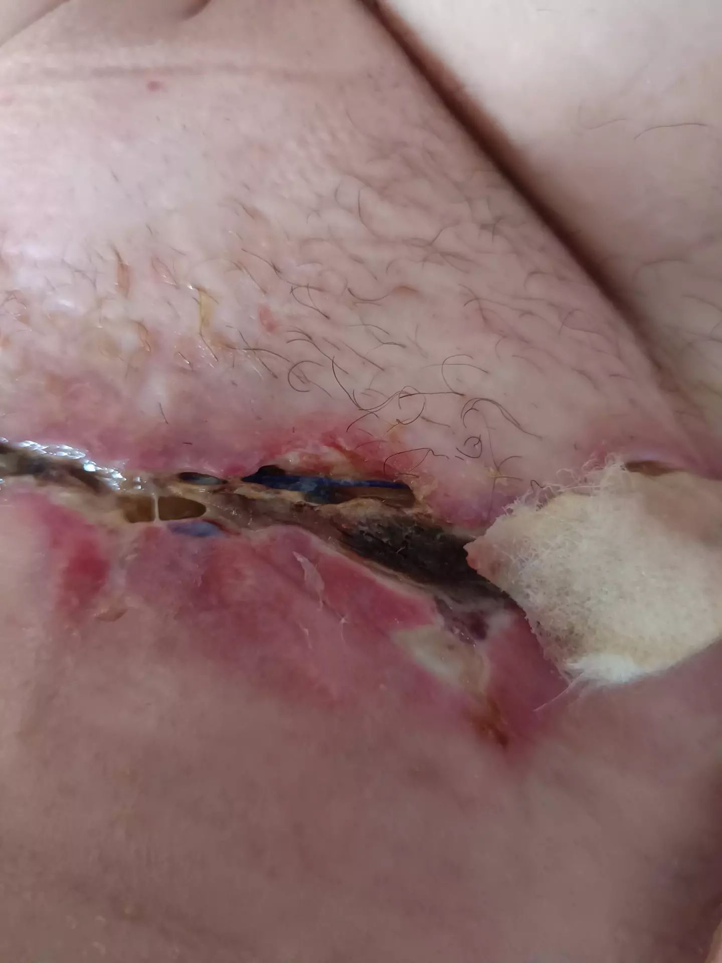 Opération abdominoplastie avec liposuccion | Estheticon.fr